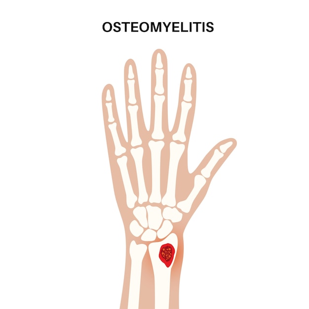Detailed Illustration of Osteomyelitis in Human Hand | Jiffy Designs