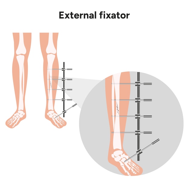Detailed Illustration of an External Fixator for Leg Fractures | Jiffy ...