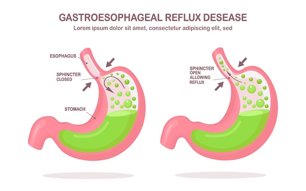 Colorful Diagram of Gastroesophageal Reflux Disease Anatomy | Jiffy Designs