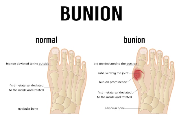 Detailed Foot Anatomy Diagram Contrasting Normal and Bunion Conditions ...