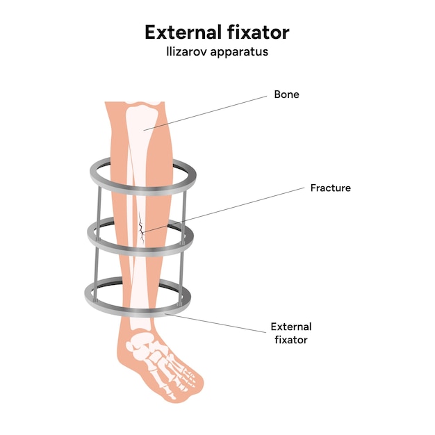 Detailed Illustration of an External Fixator Device for Bone Fracture ...
