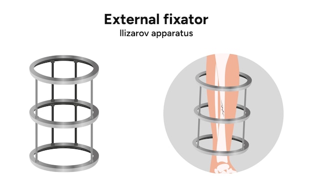 Sturdy External Fixator Device for Medical Treatment | Jiffy Designs