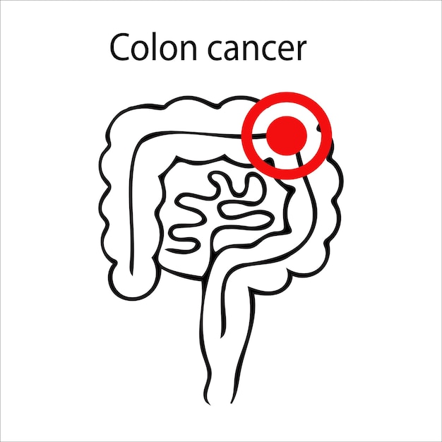 Simplified Anatomical Illustration of Colon Cancer Tumor | Jiffy Designs