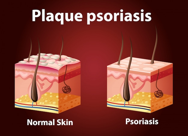 Detailed Illustration of Psoriasis and Healthy Skin Layers | Jiffy Designs