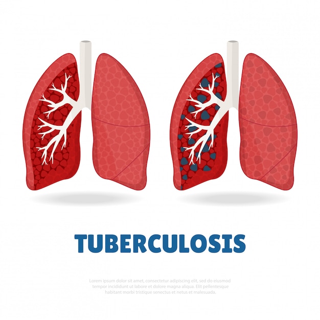 Detailed Illustration of Human Lungs Highlighting Tuberculosis | Jiffy ...