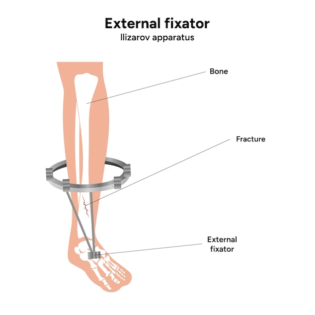 Detailed Illustration of an External Fixator Device for Bone Fractures ...