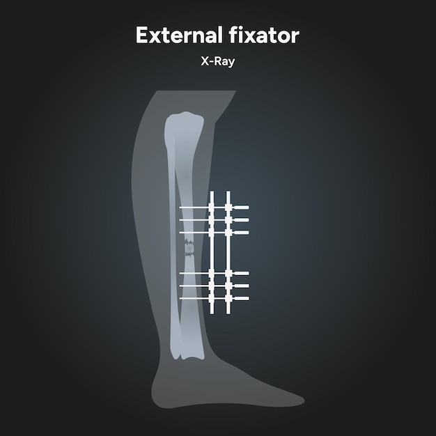 Detailed X-Ray Illustration of an External Fixator Device | Jiffy Designs