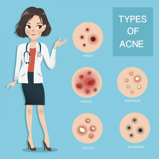 Informative Medical Illustration Depicting Different Acne Types | Jiffy ...