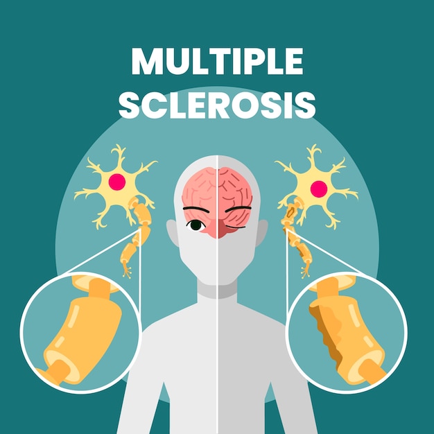 Exploring the Complexities of Multiple Sclerosis: An Informative ...