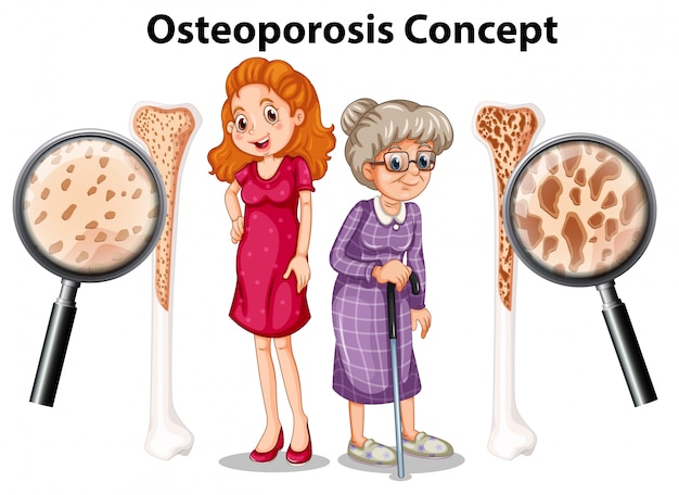 Osteoporosis Concept: Healthy Bones and Fragile Bones Comparison ...