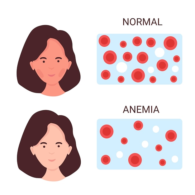 Contrasting Blood Cell Patterns: Normal and Anemic Conditions | Jiffy ...