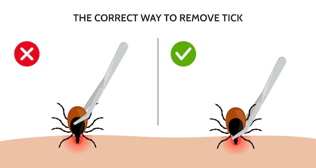 Proper Tick Removal Technique Illustrated with Cartoon Images | Jiffy ...
