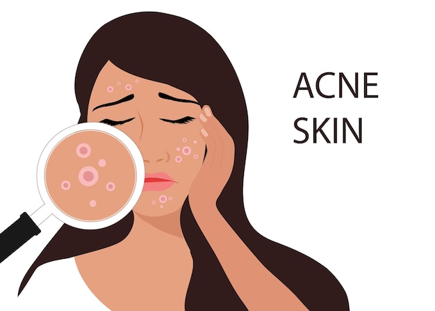 Closeup of Woman's Acne-Prone Skin Under Magnifying Glass | Jiffy Designs