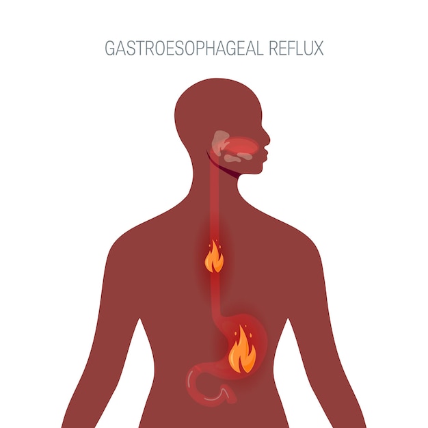 Vivid Illustration of Gastroesophageal Reflux Condition | Jiffy Designs