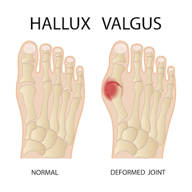 Detailed Illustration of Hallux Valgus Foot Condition | Jiffy Designs