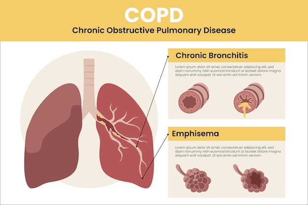 Comprehensive Guide to Chronic Obstructive Pulmonary Disease (COPD ...