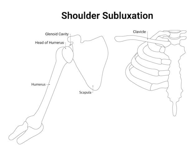 Detailed Anatomical Diagram of Shoulder Subluxation Injury | Jiffy Designs